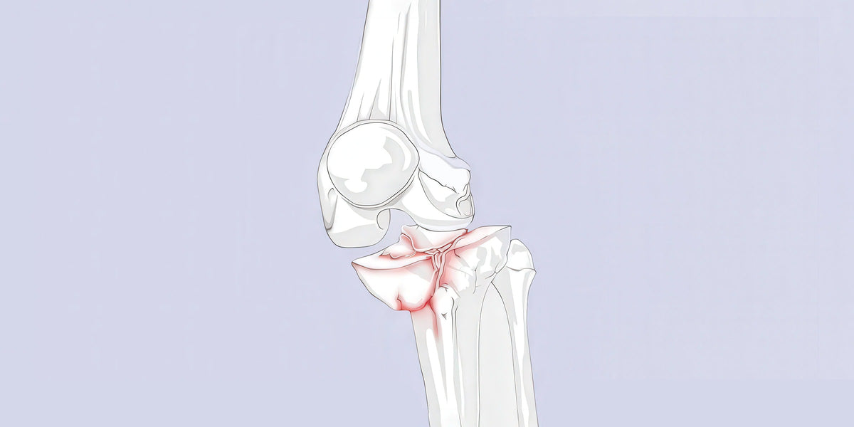 Fractured Knee - The Complete Injury Guide — Vive Health