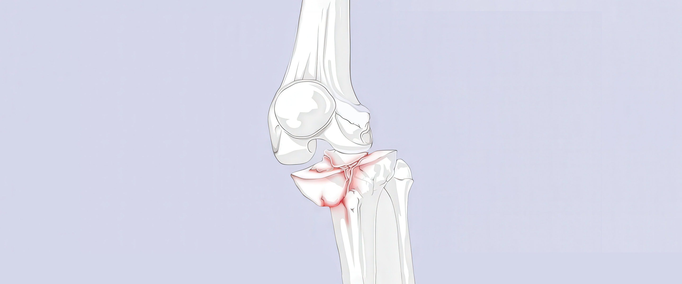 Fractured Knee - The Complete Injury Guide — Vive Health