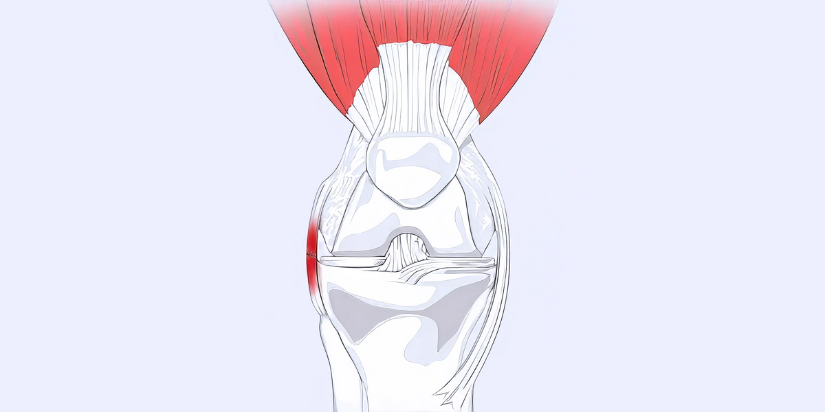 LCL Tear - The Complete Injury Guide — Vive Health