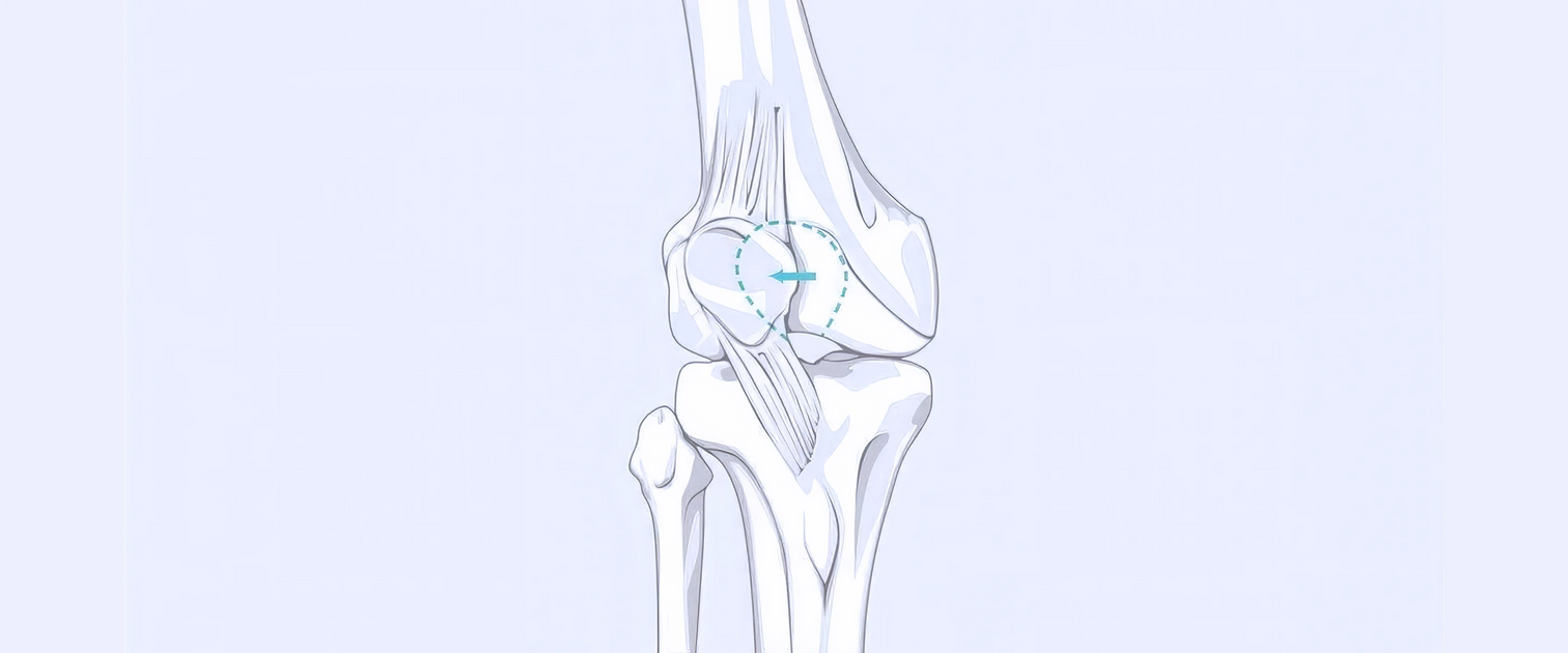 Patellar Dislocation - The Complete Injury Guide — Vive Health