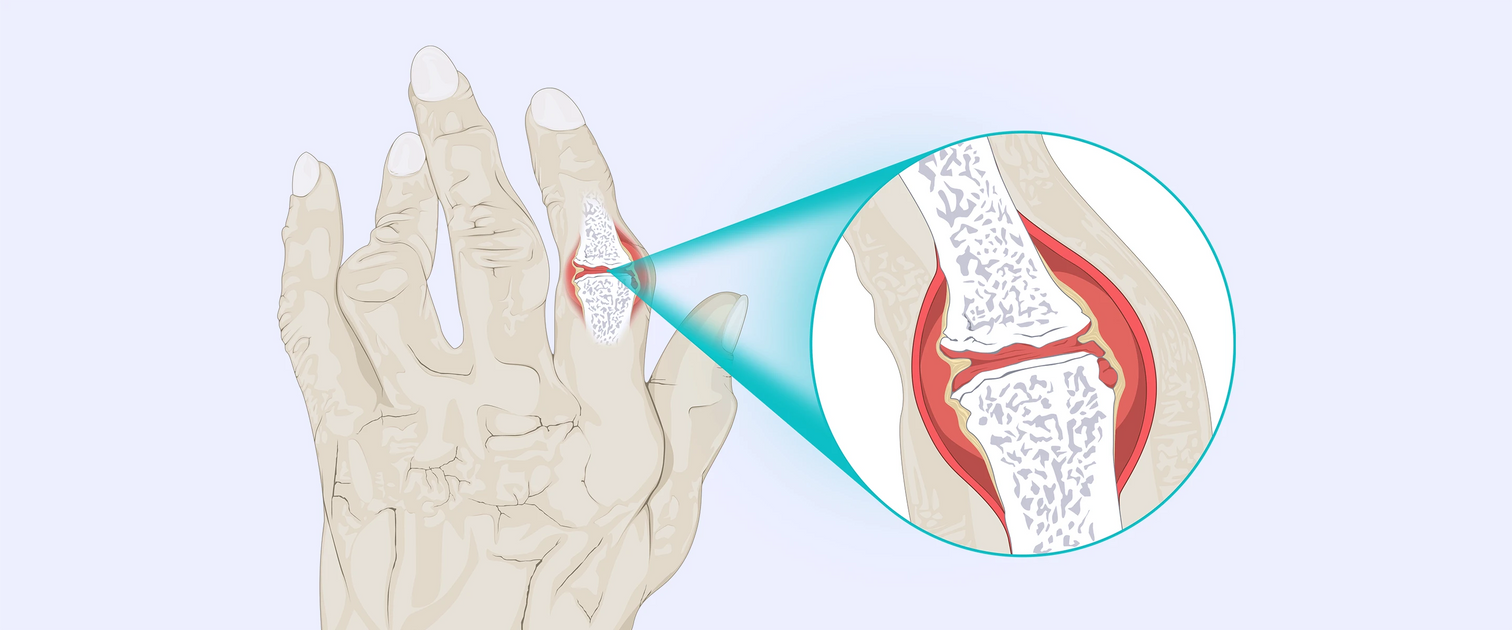 Rheumatoid Arthritis - The Complete Guide — Vive Health