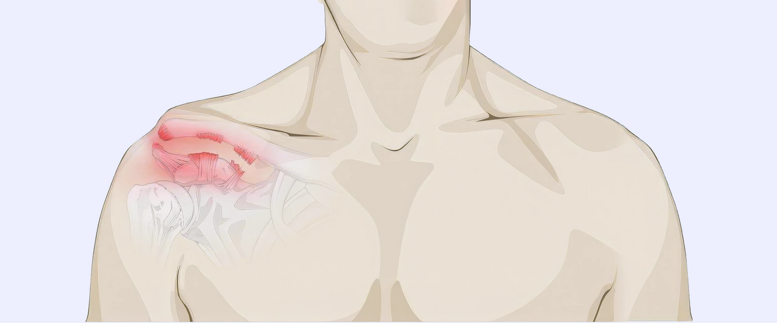 Shoulder Separation - The Complete Injury Guide — Vive Health